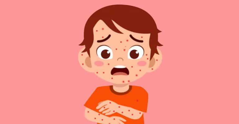 Boginje - Kako se leče ovčije boginje tj Varičele i moguće komplikacije?